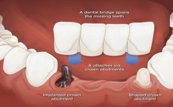 Dentist | Dental Clinic Banani | Cosmetic Filling | Promident Dental Clinic