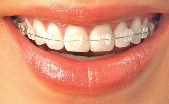 Dental Bridge - Promident Dental