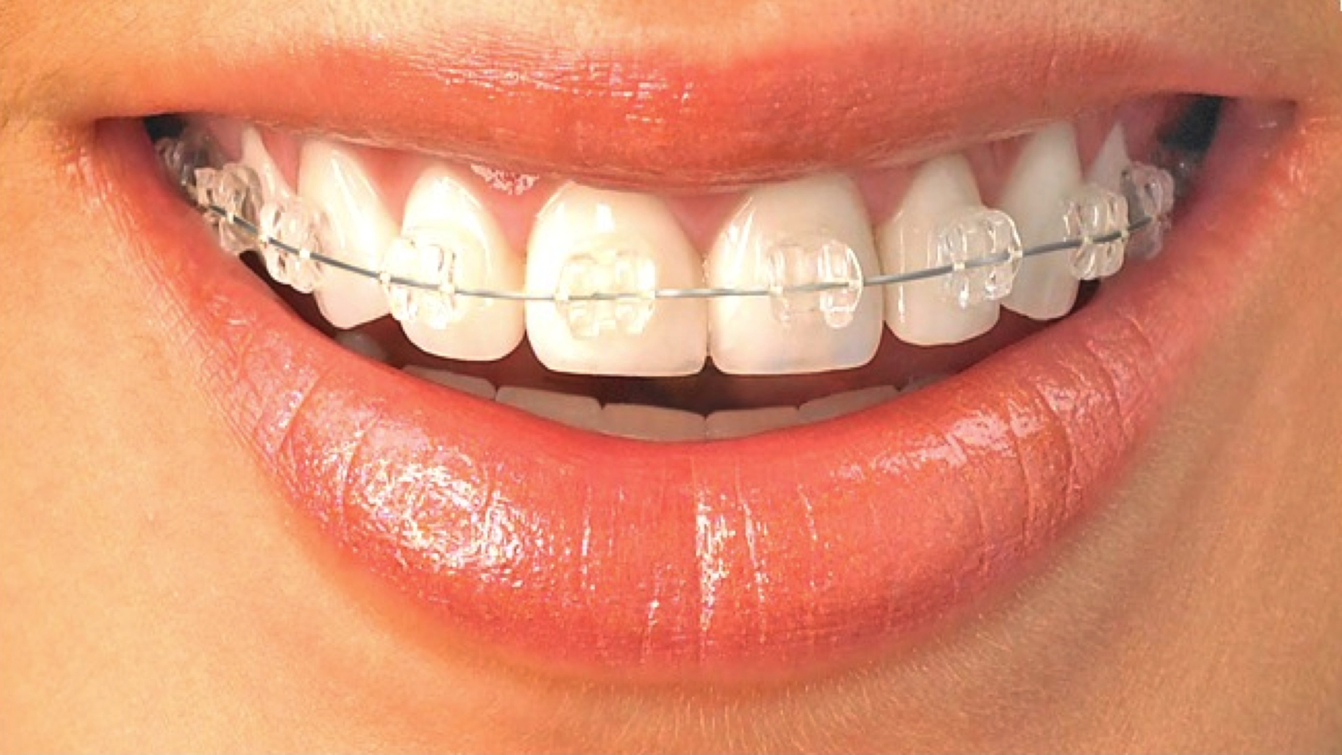 Orthodontic Braces - Promident Dental